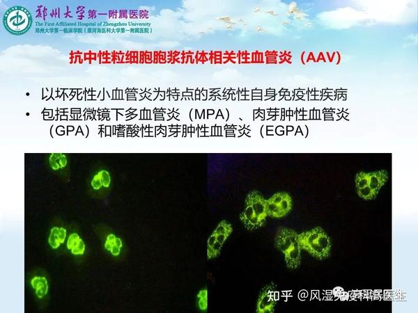 2022年ANCA相关血管炎诊疗进展 - 知乎