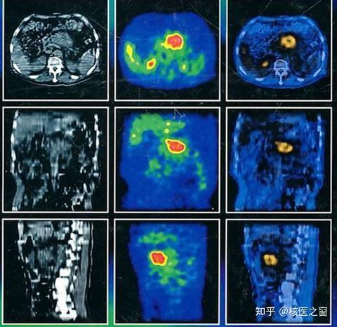 【解惑】PET/CT检查报告里的SUV值是什么？ - 知乎