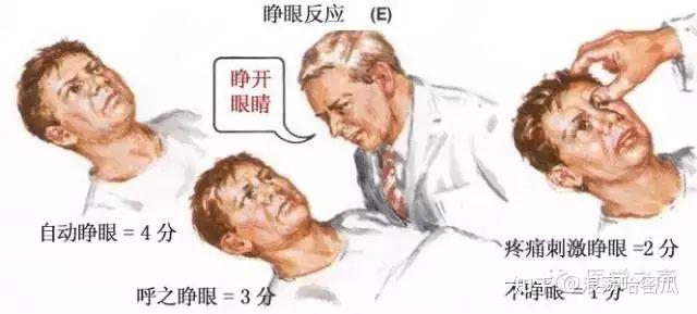 昏迷指数 | 格拉斯哥昏迷评分（GCS） - 知乎
