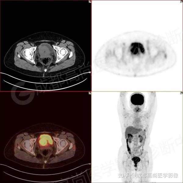 【高尚病例】PET/CT诊断尿道平滑肌肉瘤1例 - 知乎