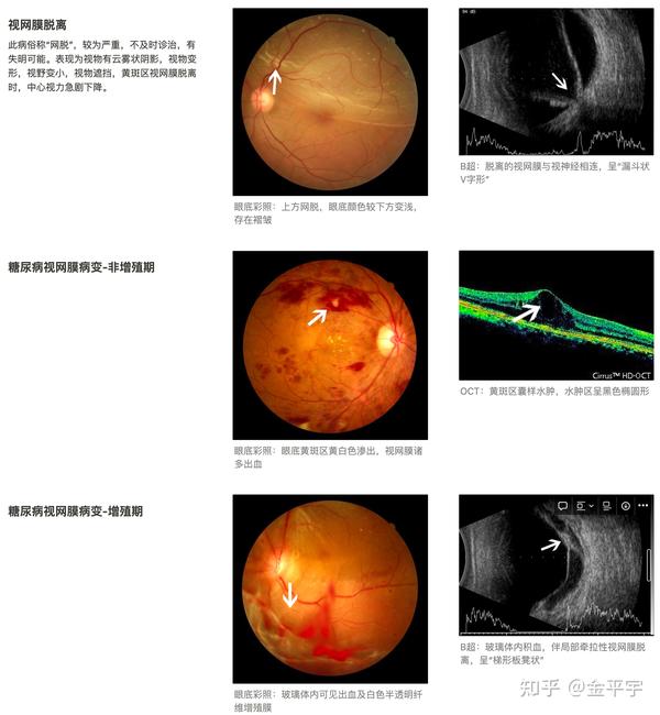 抗VEGF药物在眼底疾病治疗中的市场机遇与挑战 - 知乎