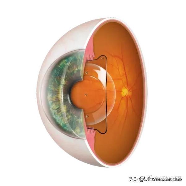ICL晶体植入手术和其他近视手术的区别 - 知乎