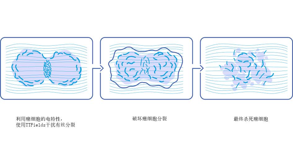 肿瘤治疗场便携式设备Optune Lua在美获批用于治疗非小细胞肺癌 - 知乎