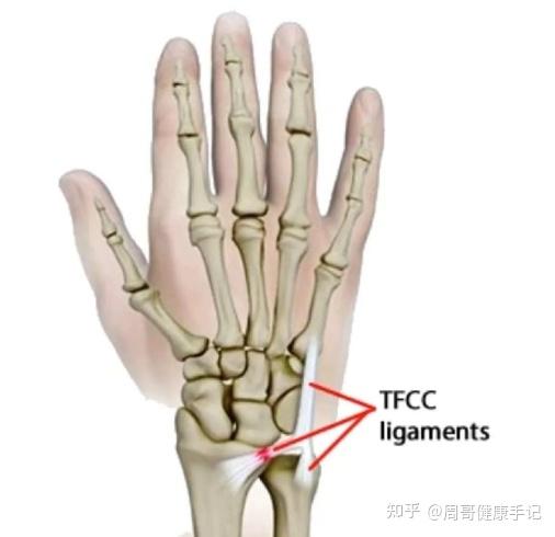 手腕TFCC损伤保守治疗大半年，终于好了 - 知乎