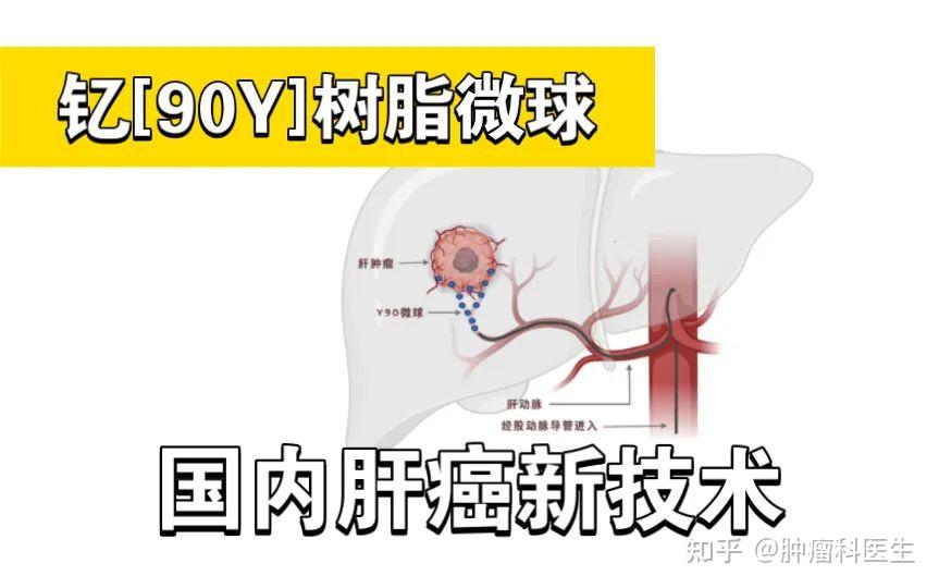 钇90微球疗法，癌症患者新希望 - 知乎