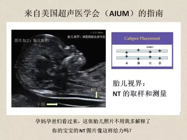 孕妈们，你的胎儿的 NT 检查结果可靠吗？ - 知乎