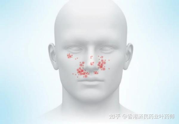 面部血管纤维瘤新药：Hyftor(西罗莫司局部凝胶)！用药前需要知道的那些事儿 - 知乎