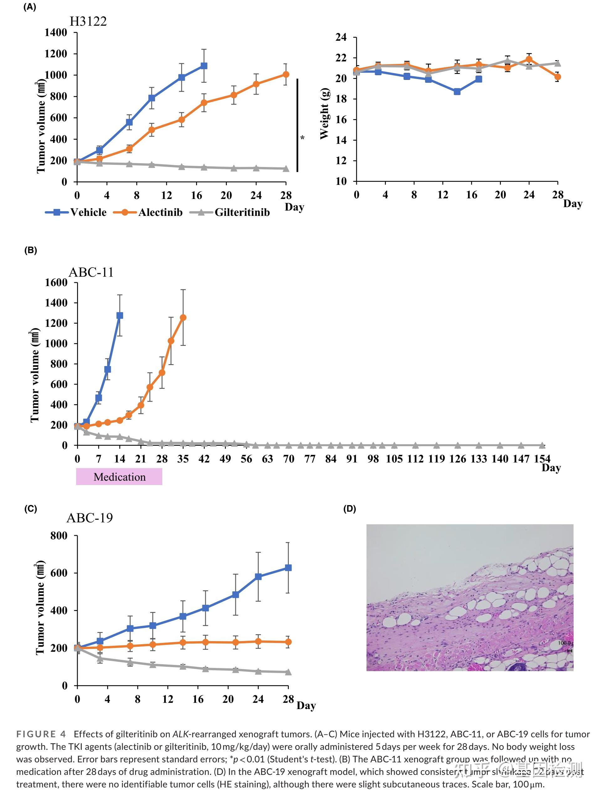 Gilteritinib吉瑞替尼与阿来替尼治疗ALK重排非小细胞肺癌的疗效比较 - 知乎