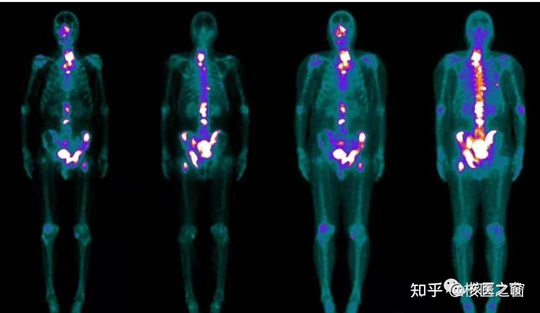 SPECT显像主要检查项目都有哪些? - 知乎
