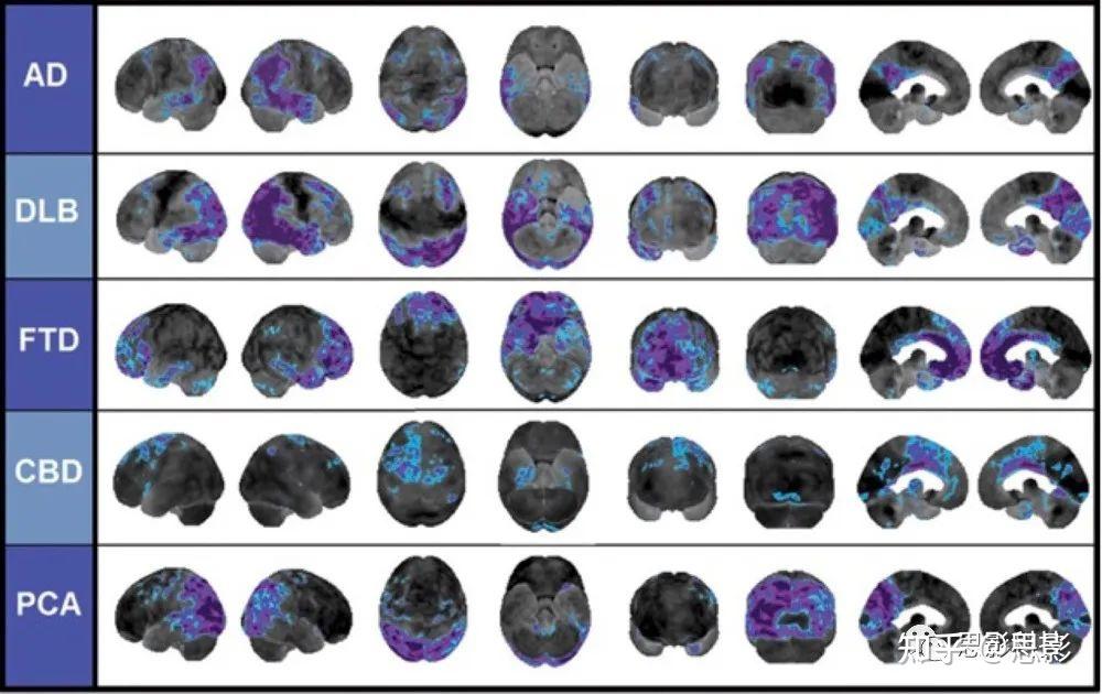 Radiology：神经影像学在痴呆症中的应用 - 知乎