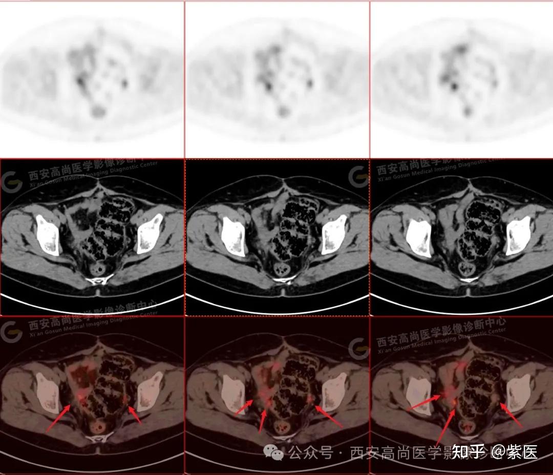 18F-FDG PET/CT-MR多模态显像诊断粘液腺癌术后肝包膜转移 - 知乎