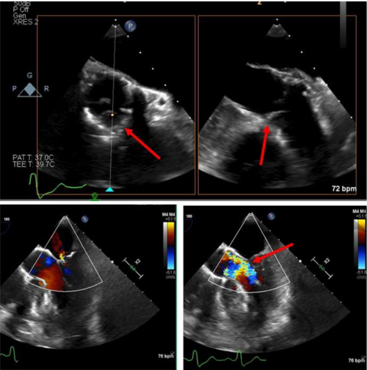 病例丨感染新冠竟引起瓣膜血栓？瓣中瓣TAVR技术成功治疗90岁高龄主动脉生物瓣衰败 - 知乎