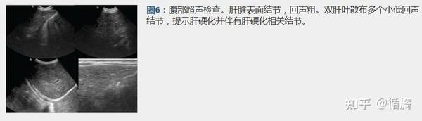 Pearson Syndrome皮尔逊综合征（PS）引起贫血、胰腺外分泌缺陷、视力异常的线粒体疾病 - 知乎