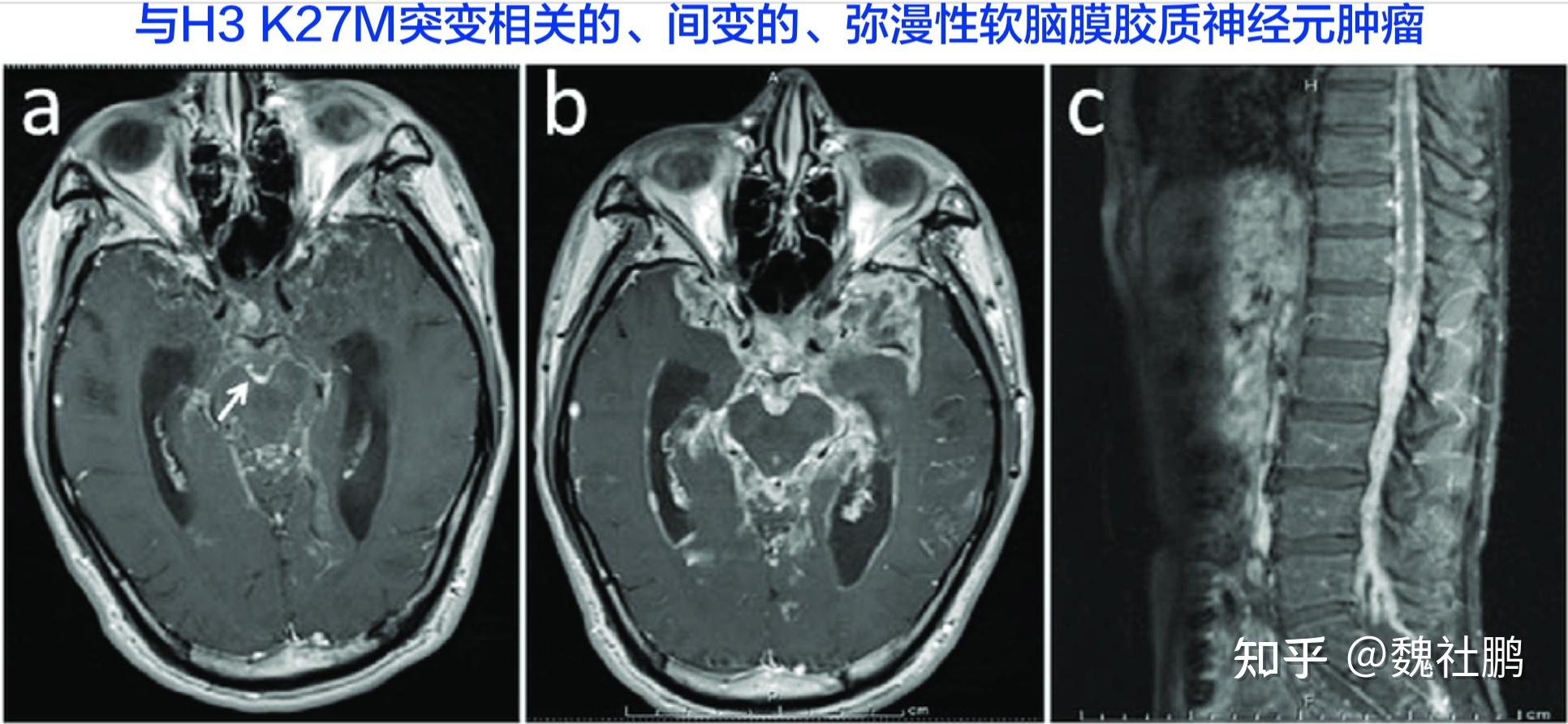 弥漫性软脑膜胶质神经元肿瘤 - 知乎