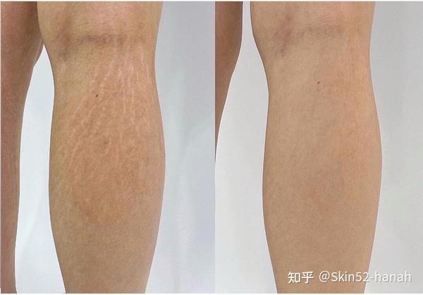 腿上有肥胖纹怎么办? 知乎