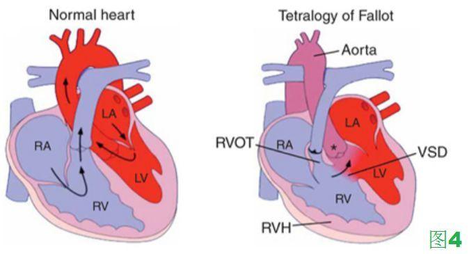 【临床病例】Tetralogy of Fallot (TOF) 法洛四联症 - 知乎