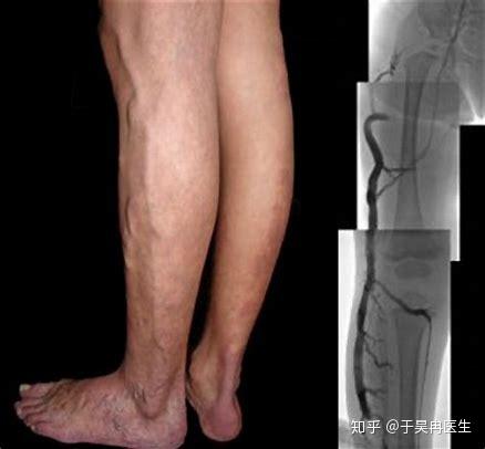 KTS---静脉畸骨肥大综合征(Klippel-Trenaunay syndrome) - 知乎