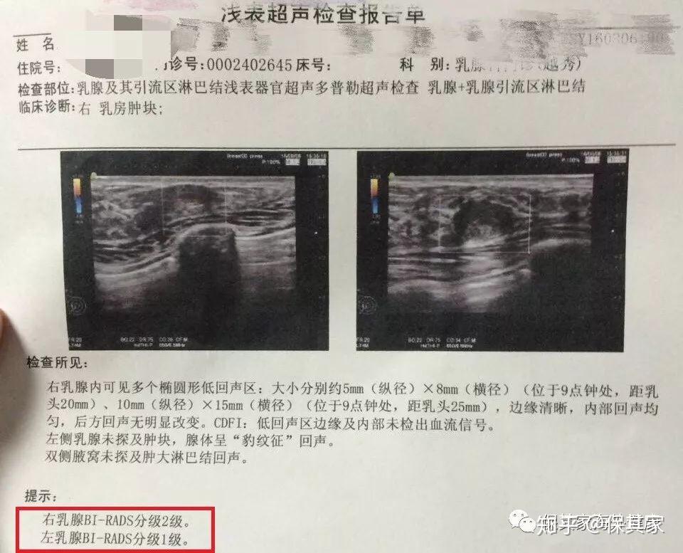 什么情况下,你需要担心乳腺结节会恶化成乳腺癌。 知乎