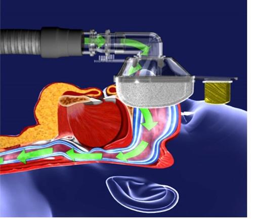 医疗器械技术科普与商业解读－持续呼吸道正压通气呼吸机CPAP - 知乎