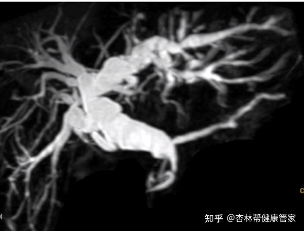 MRCP的科普 - 知乎