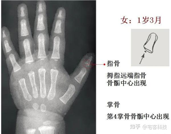 儿童生长发育骨龄图谱丨建议收藏！ - 知乎