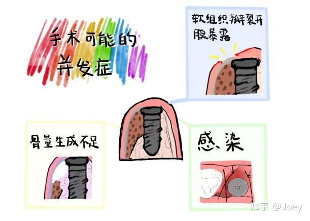 引导骨再生膜比对分析——贝奥吉因CDMO - 知乎
