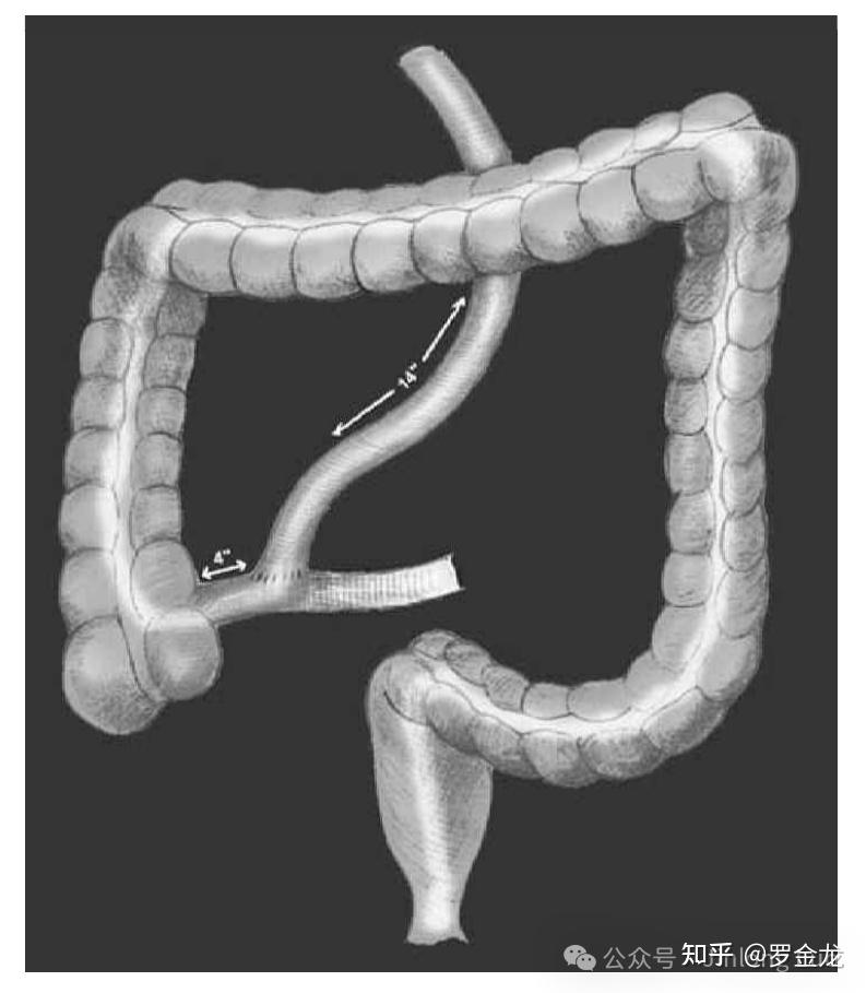 减重代谢手术的发展及历史演进 - 知乎