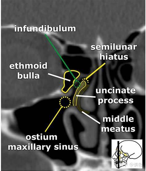 固有鼻腔外侧壁的解剖（Nasal Fossa Proper） - 知乎