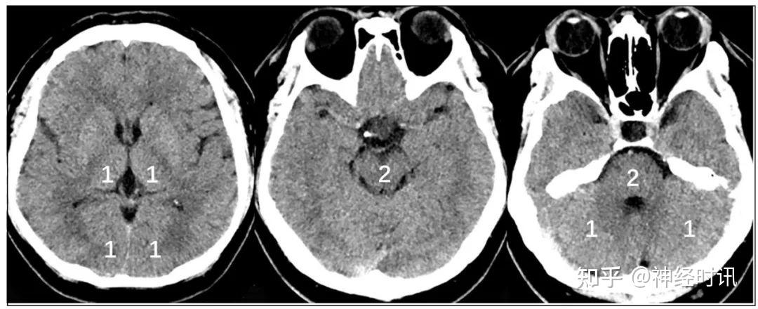指导规范 | 急性缺血性脑卒中的影像学评估 - 知乎