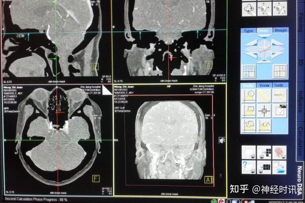 颅脑动脉系统及CTA检查技术，一文读懂 - 知乎