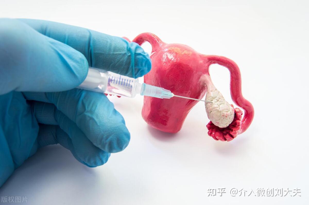 卵巢储备功能减退该如何治疗? 知乎