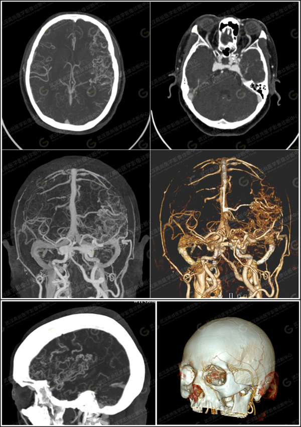 68岁女性双眼球结膜充血，CTA诊断硬脑膜动静脉瘘 - 知乎