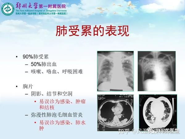 2022年ANCA相关血管炎诊疗进展 - 知乎