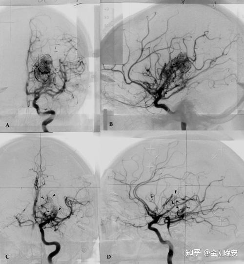 动静脉畸形（AVM）知识整理 - 知乎