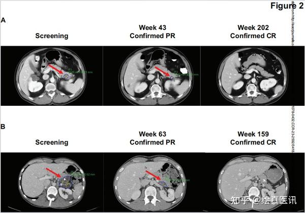 CCR | 贝组替凡对VHL相关胰腺病变继续展现持久抗肿瘤活性，LITESPARK-004中位随访≥3年 - 知乎