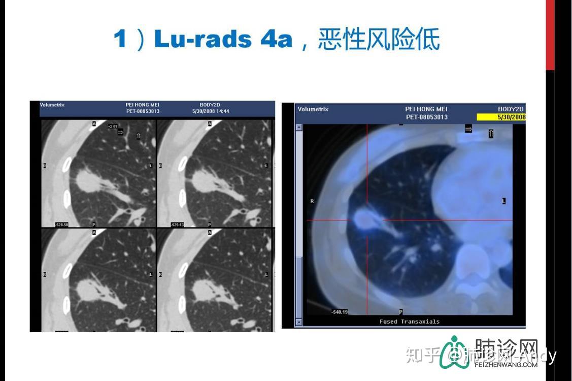 刘士远教授——肺结节lung-RADs报告分级系统解读 - 知乎
