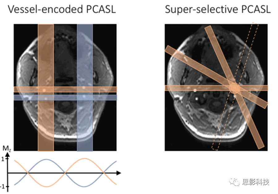 Neuroimage：ASL（动脉自旋标记）技术的发展 - 知乎