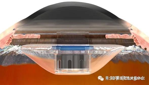 新技术 | 新植入产品或为黄斑变性患者带来前所未有的视力改善 - 知乎