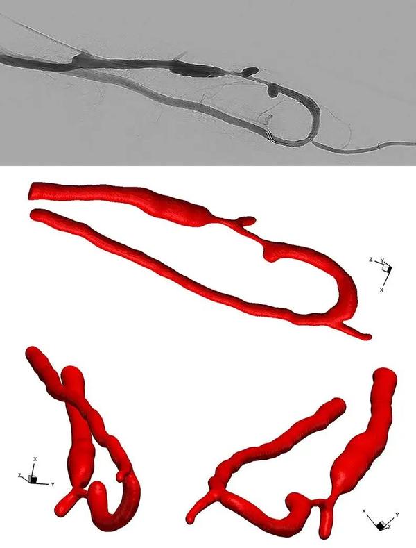 【Simpleware】利用自由式三维超声无创监测动静脉瘘 - 知乎