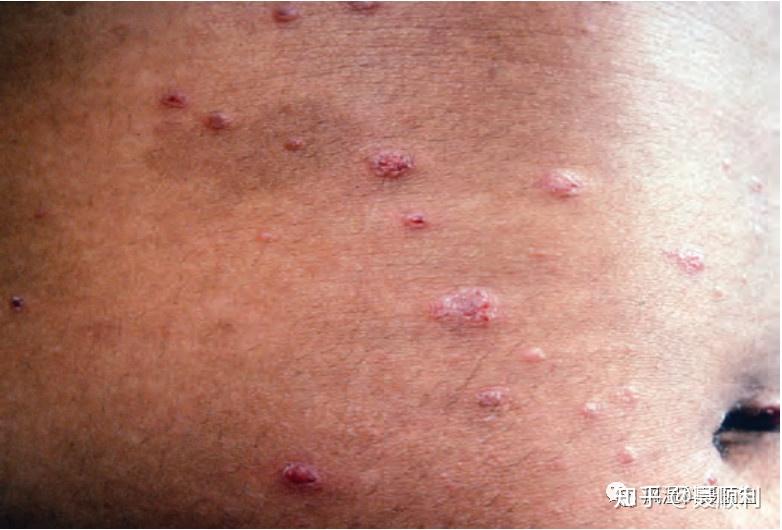 易跟过敏性紫癜混淆的疾病有哪些？（完结篇） - 知乎