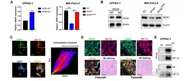 Cancer research | MTAP缺失诱导的代谢重塑增加胰腺癌嘌呤从头合成和糖酵解共靶向敏感性 - 知乎