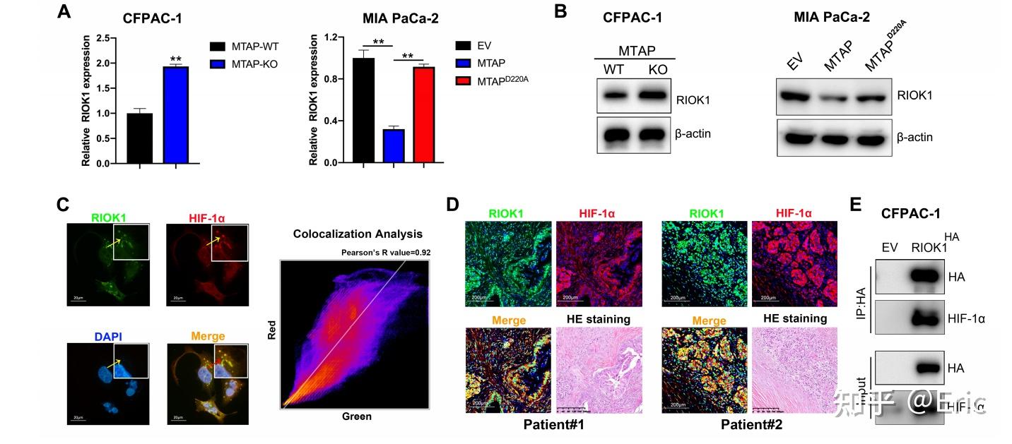 Cancer research | MTAP缺失诱导的代谢重塑增加胰腺癌嘌呤从头合成和糖酵解共靶向敏感性 - 知乎