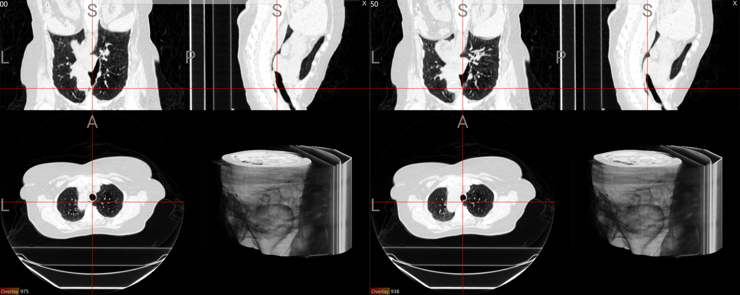 使用 voxelmorph 进行 CT 影像配准——原理和代码实现 - 知乎