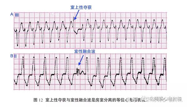 宽QRS波心动过速的鉴别诊断 - 知乎