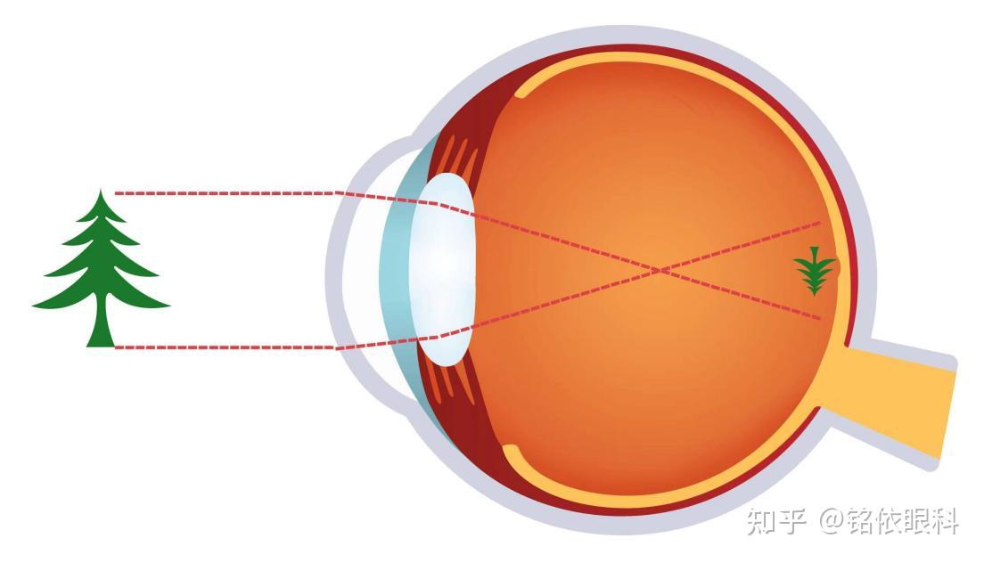 为什么ICL近视手术的视觉质量比戴眼镜要好？ - 知乎
