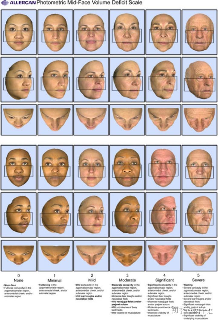 美国艾尔建公司JUVÉDERM® VOLUMA™ XC用于中面部填充的产品介绍 - 知乎