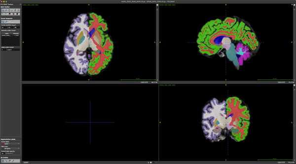 L2R-OASIS 大脑分割与配准 MR 数据集介绍 - 知乎