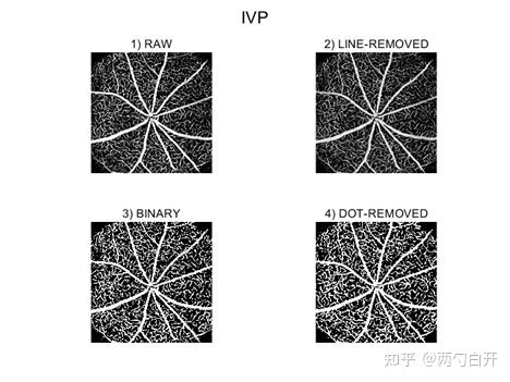 图像处理：血管分割与量化 - 知乎