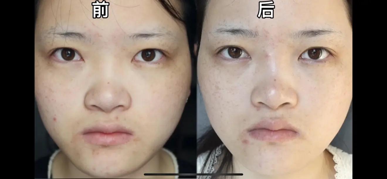 我去做超皮秒了，手术过程和30天恢复记录分享【整容】【医美】 知乎