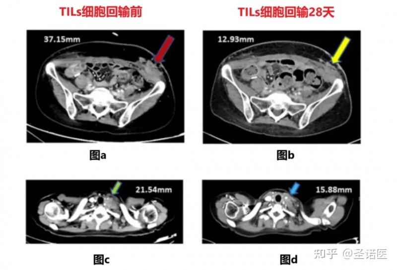 全球首款TIL细胞治疗Lifileucel(Amtagvi)在加拿大获批,国产TIL细胞疗法接力暴击肺癌、卵巢癌、宫颈癌等 - 知乎
